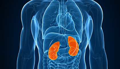 Akutna okvara in akutna odpoved ledvic | Onkonefrologija